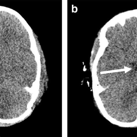 Effect Of All Three Levels Of Peep On Onsd And Icp Download Scientific Diagram