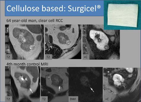 Figure 1 From Magnetic Resonance Imaging Features Of Hemostatic Agents