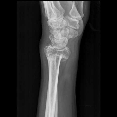 Smith Fracture Radiology Case Neck Fracture