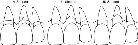 7 Facial Bone Defect Classification V Shaped Defect Isolated Only To