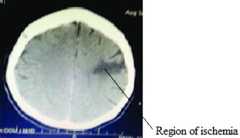 Axial Computed Tomography Scan Of The Brain Obtained At The Level Of Download Scientific