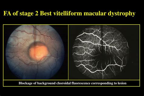 Ppt Hereditary Retinal Dystrophies Powerpoint Presentation Free