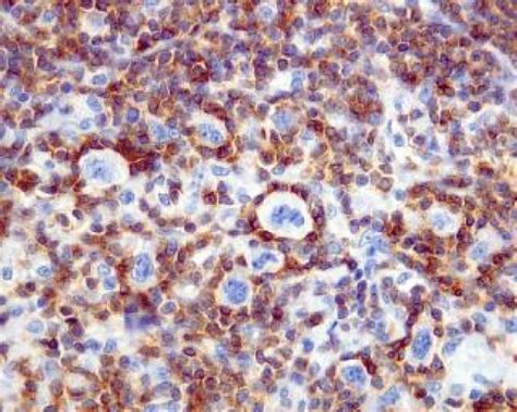 The Sentient Propagation Reactive B Cell Rich Lymphoid Proliferation