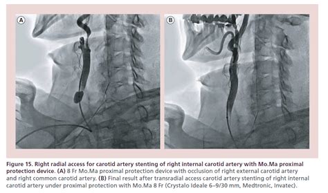 Transradial Carotid Artery Stenting Examining The Alternatives When