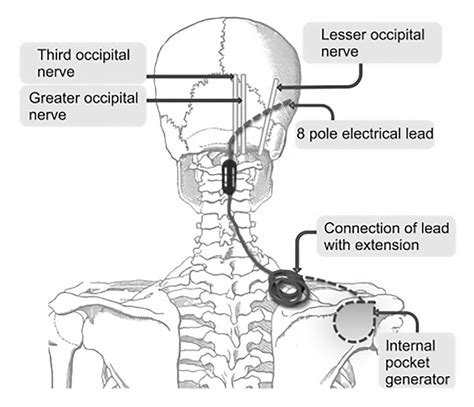 Cpt Code Occipital Nerve Block At Marcos Hines Blog