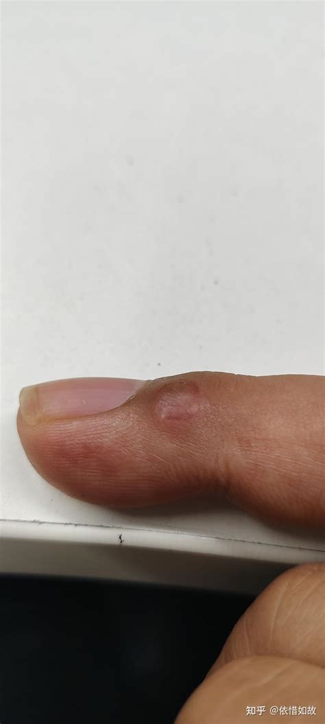 自己买了罐液氮，亲自下手冻瘊子 知乎