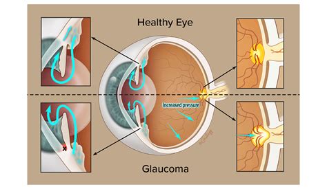 Glaucoma Laser Vision Me