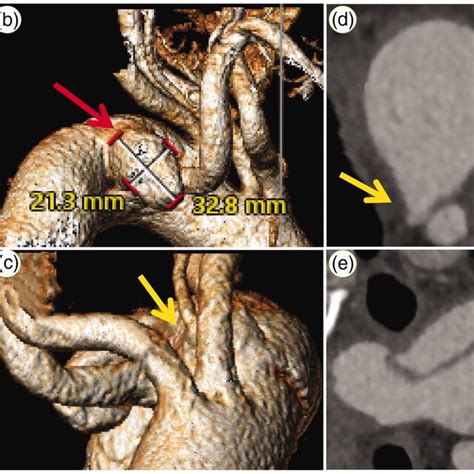 Cta Findings Confirming Type B Aortic Dissection Involving Three Rare