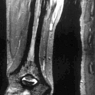 Axial Magnetic Resonance Imaging Scan Of The Distal Humerus Of A 25