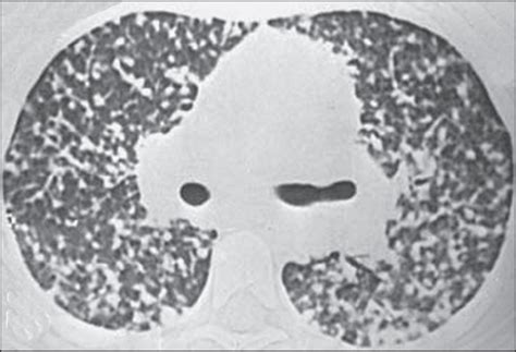 Brasil Computed Tomography Findings Of Pulmonary Histoplasmosis