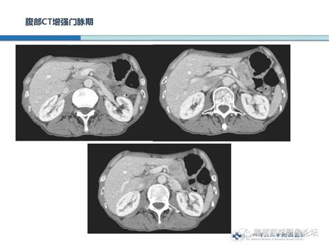 胰腺神经内分泌癌1例ct影像 医学百科网