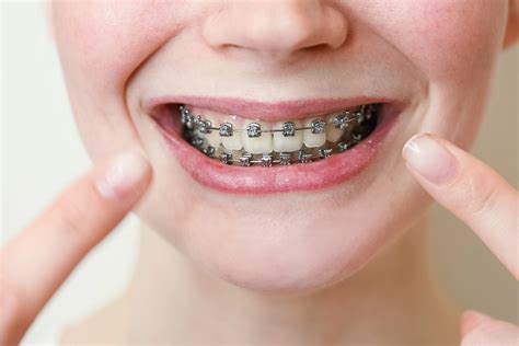 Traditional Braces In Sacramento Ca Dr Smita Khandwala Dds