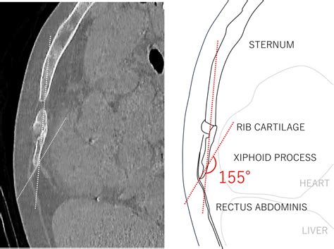 Xiphodynia With Limited Decrease In The Xiphoid Process Sternal Angle But Recognised Compression Xiphodynia With Limited Decrease In The Xiphoid Process Sternal Angle But Recognised Compression