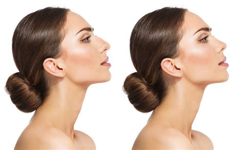 Stages Of Rhinoplasty Swelling Post Surgery Dr Brent Blog
