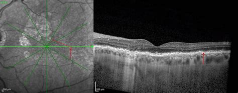 Ir Oct Image Showing A Diffuse Bruch Rpe Splitting After Identifying Download Scientific