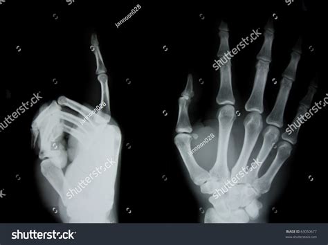 Broken Finger Tip X Ray