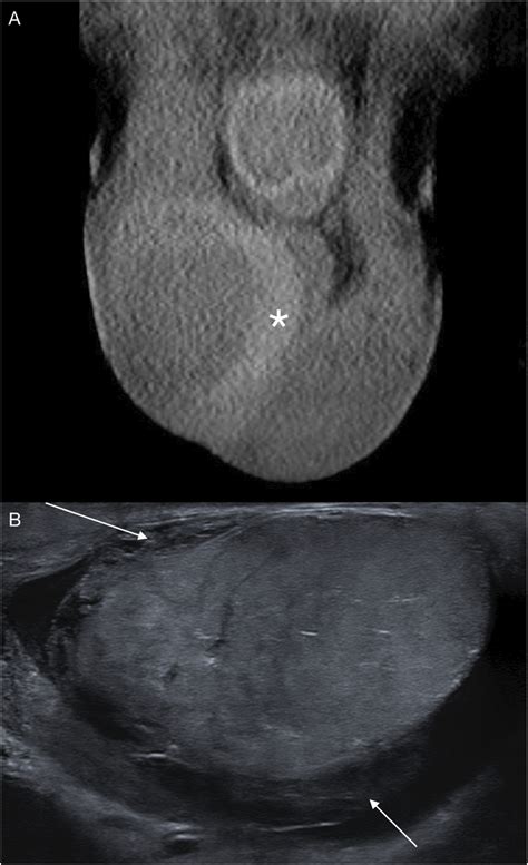 Traumatic Testicular Rupture Multimodality Imaging With Intraoperative