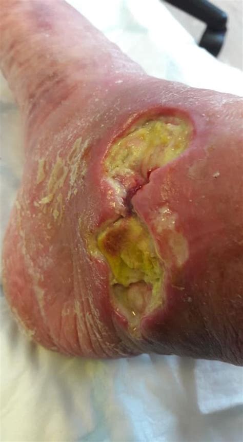 Ankle Update Acute Cellulitis 6wks 2 Days Doppler Scan Scheduled