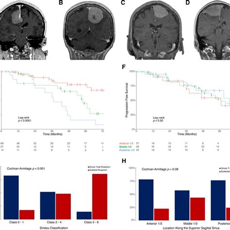 Representative Mri Scans For A Parafalcine Meningioma Sindou “class