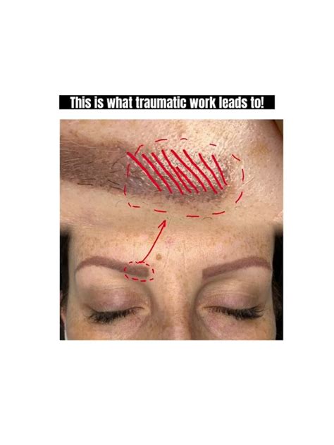 Skin Scars After Microblading Youtube