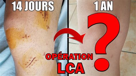 OpÉration Lca Ép 19 Et Les Cicatrices Youtube