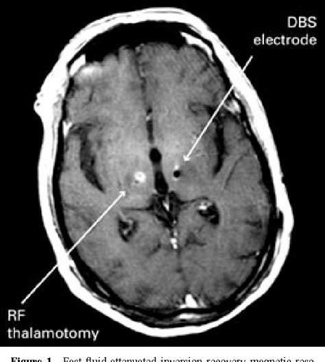 Figure 1 From Acute Insomnia Following Surgery Of The Ventralis