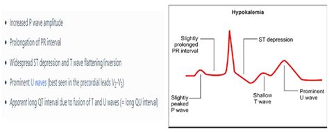 Hyperkalemia Ecg