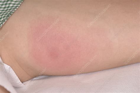 Allergic Reaction To An Insect Bite Stock Image C0472831 Science Photo Library