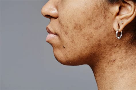 How To Get Rid Of Black Spots From Acne Effective Treatments