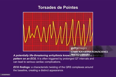 Ecg Displaying Torsades De Pointes Rhythm Illustration High Res Vector