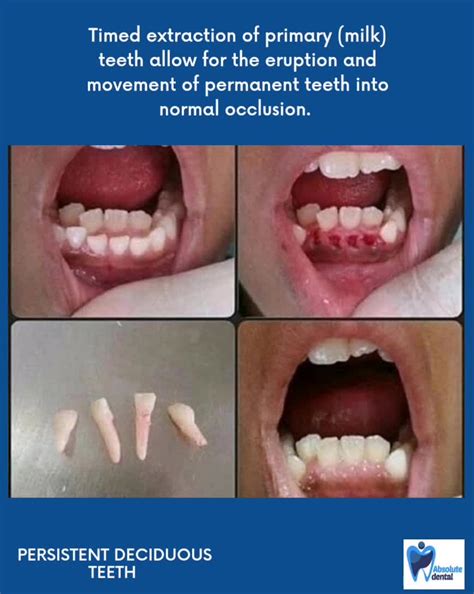 Extraction Of Deciduous Teeth For More Information Feel Free To