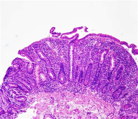 Enteropathy Associated With Olmesartan Ge Portuguese Journal Of