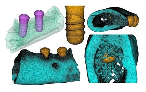Trabecular Microstructure Mandible Model Containing 2 Osseointegrated