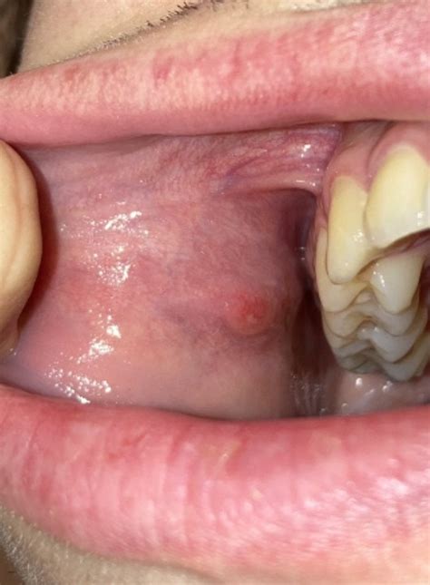 Canker Sore Or Abscess Rdentalhygiene Canker Sore Or Abscess Rdentalhygiene