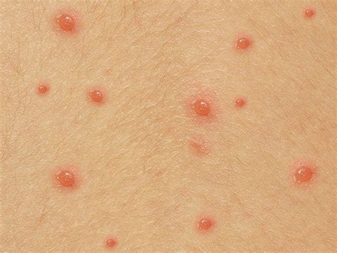 Can A Fetus Get Chicken Pox At Carolyn Huddleston Blog