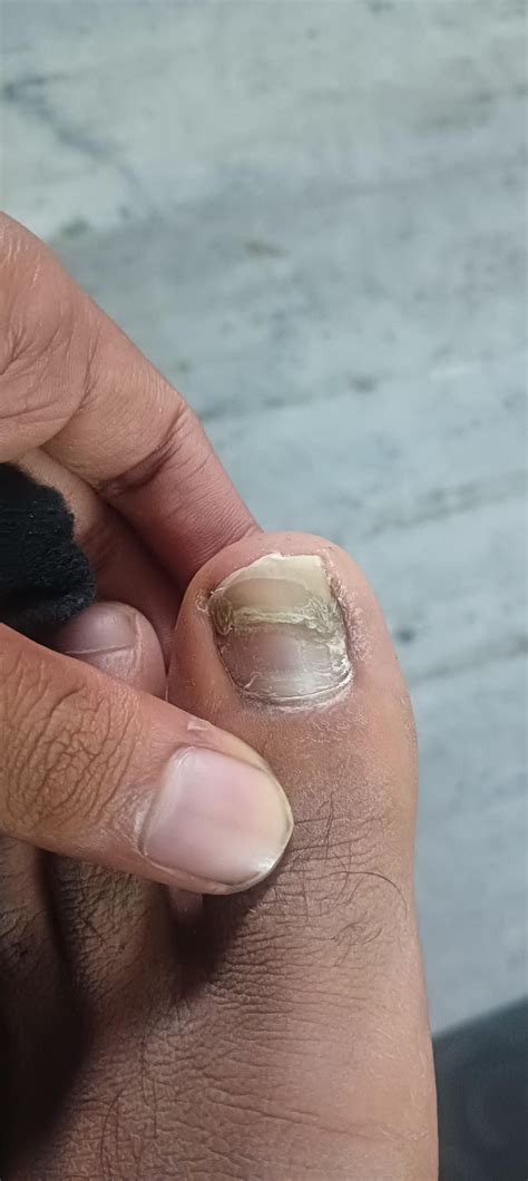 This Happened After My Ingrown Toenail Fixed Naturally R Ingrown Toenails