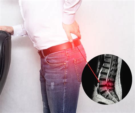 A Comprehensive Guide To Understanding Sciatica Diagnosing And Treating