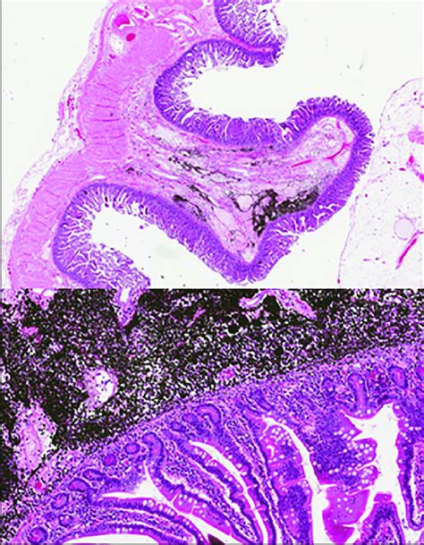 Microscopic Examination Of The Resected Segment Of The Jejunum Showed