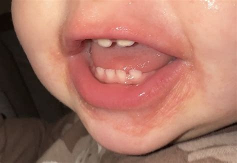 Help 18mo Ds Has Persistent Rash Around Mouth Mumsnet