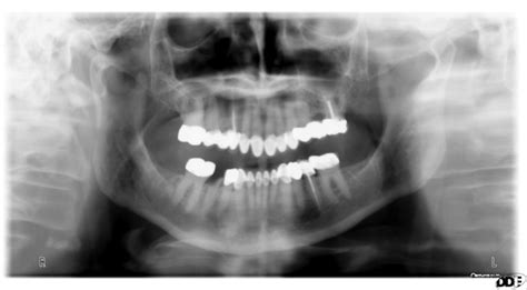 Anatomy Monday Hamulus Dr Gs Toothpix