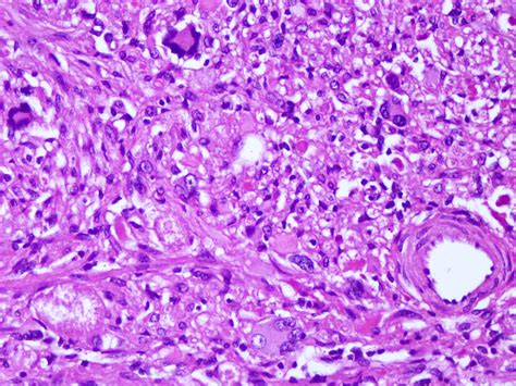 Pathology Outlines Pleomorphic Xanthoastrocytoma