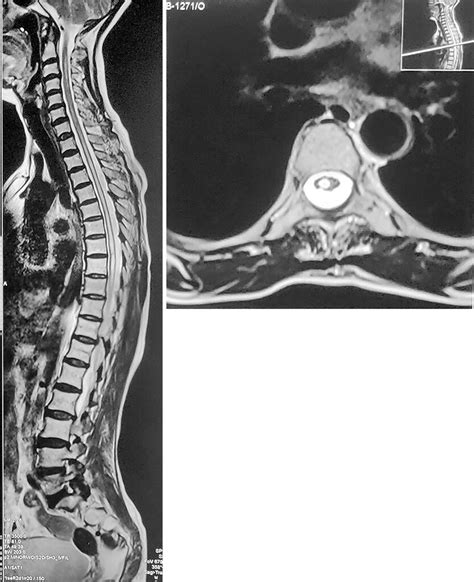 Single Level Ossified Ligamentum Flavum Causing A Holocord Syrinx
