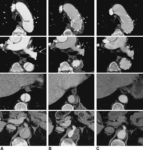 Contrast Enhanced Ct Of Acute Type B Dissection A And Comparable Ct