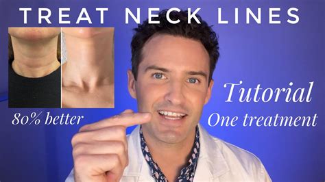 How To Lose Lines On Neck At Erin Love Blog