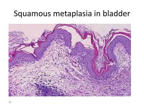 Ppt Bladder Carcinoma Powerpoint Presentation Free Download Id 4505324