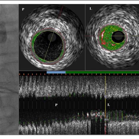 Ivus Analysis At Evaluated Segments P Indicates Proximal Reference
