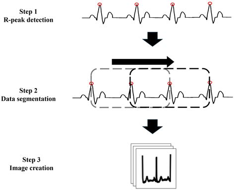 Preprocessing Free Convolutional Neural Network Model For Arrhythmia Classification Using Ecg Images