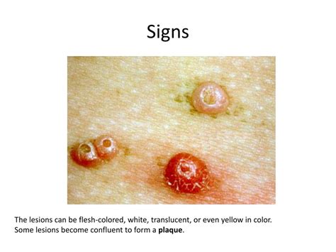 Ppt Molluscum Contagiosum Powerpoint Presentation Free Download Id