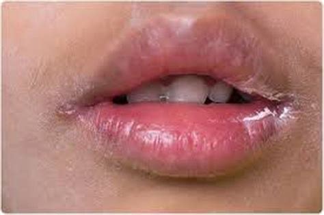 Risk Factors Of Angular Cheilitis Medizzy