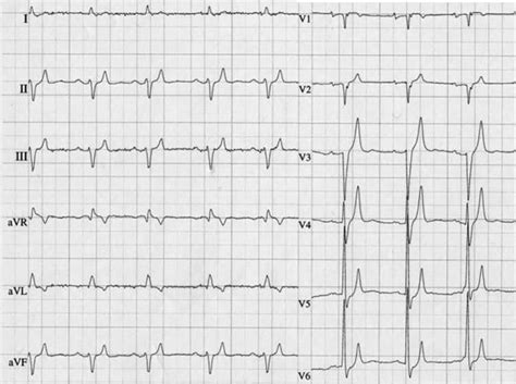 Syndróm Krátkeho Qt Intervalu Ekg Kniha Techmed